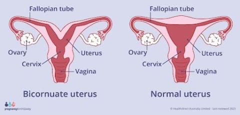 Bicornuate Uterus And Pregnancy Care Mamata Fertility Hospital