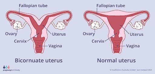 Bicornuate uterus and pregnancy care | Mamata Fertility Hospital