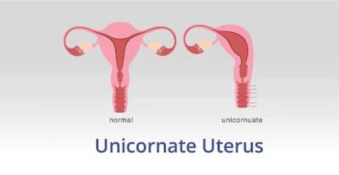 Unicornuate uterus and pregnancy | Mamata Fertility Hospital