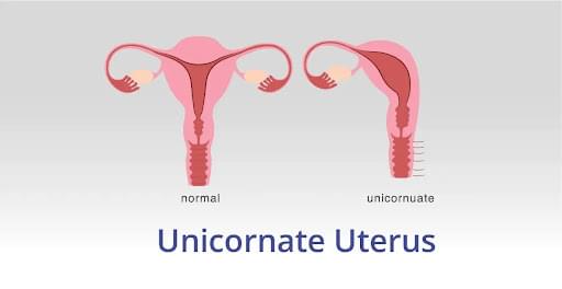 Unicornuate uterus and pregnancy | Mamata Fertility Hospital